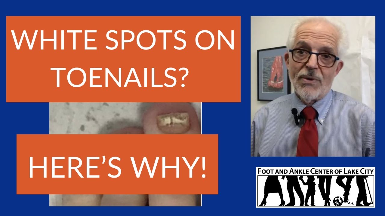 5 Most Common Causes of White Spots on Toenails | Foot and Ankle Center ...