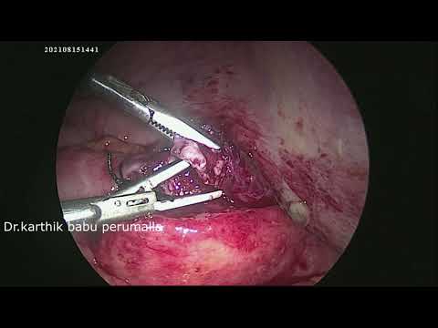 Laparoscopic Retrograde Appendicectomy for Perforated Retrocaecal appendix