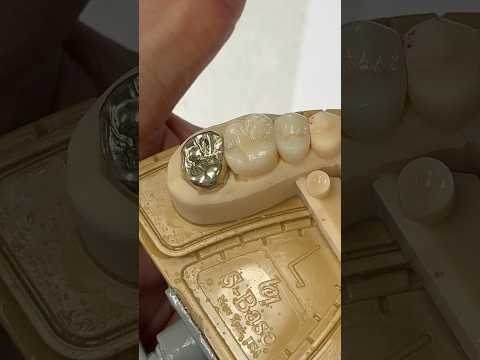 Zen Enamel and #Gold Crowns @EnvisiontecMain #envisiontec #dental #teeth #smile #lsk121shorts