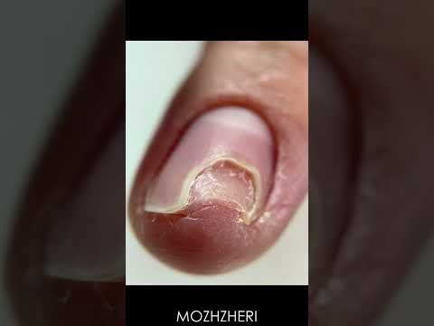 Onycholysis, MOZHZHERI