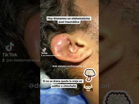 Otohematoma, antes y después.