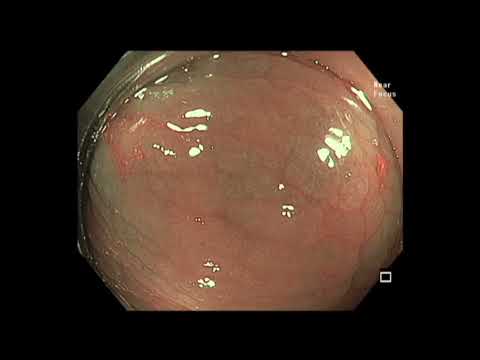 Sessile Serrated Adenoma in Crohn's disease EMR
