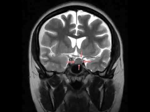 Pituitary Adenoma causing left visual disturbance