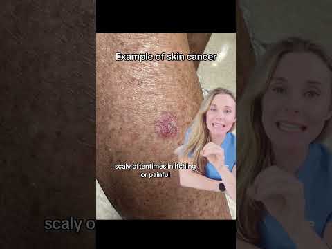Would you recognized this common skin cancer? #skincancer #dermatologist