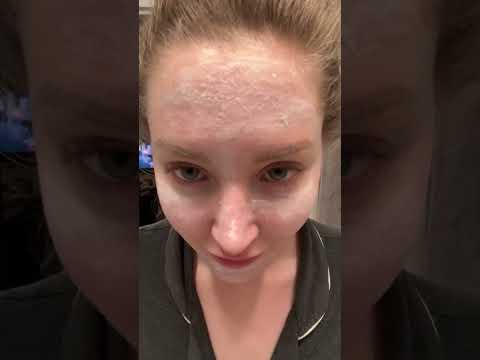 Chemical Peel Before and After