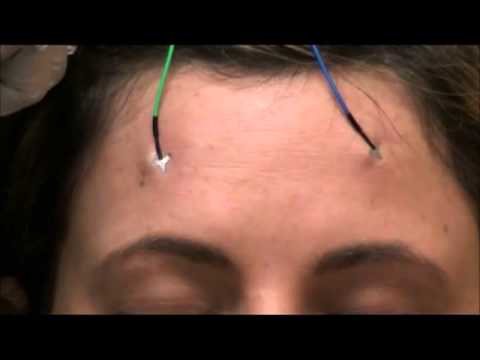 Needle Electrodes - RF Cautery Needle Electrode Latest Price ...