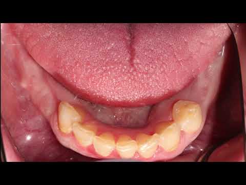 Multiple teeth were extracted and replaced with SDS dental implants by Dr. Manesh.