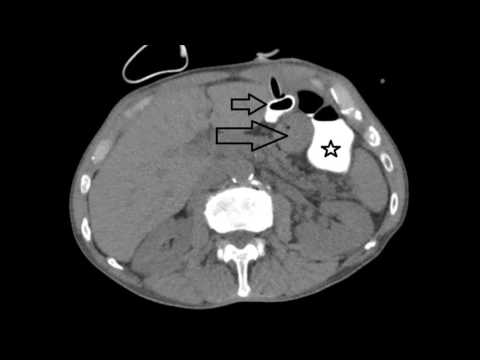 Colonoscopic-Assisted Percutaneous Endoscopic Gastrostomy Tube Placement