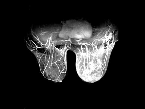 Breast MRI