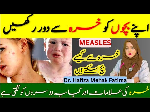 khasra ki Alamat or ilaj | Measles Treatment | khasra ki bimari dosron ko bhi lg skti hai