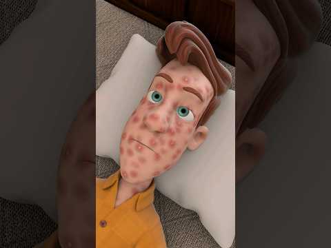 Causes of blisters in chicken pox? चेचक में छाले क्यों होते हैं? 3D Animation #shorts