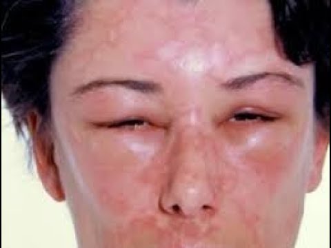 Anaphylaxis in pediatrics
