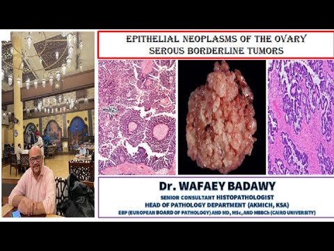 EPTHELIAL NEOPLASMS OF THE OVARY SEROUS BORDERLINE TUMORS BY DR WAFAEY BADAWY
