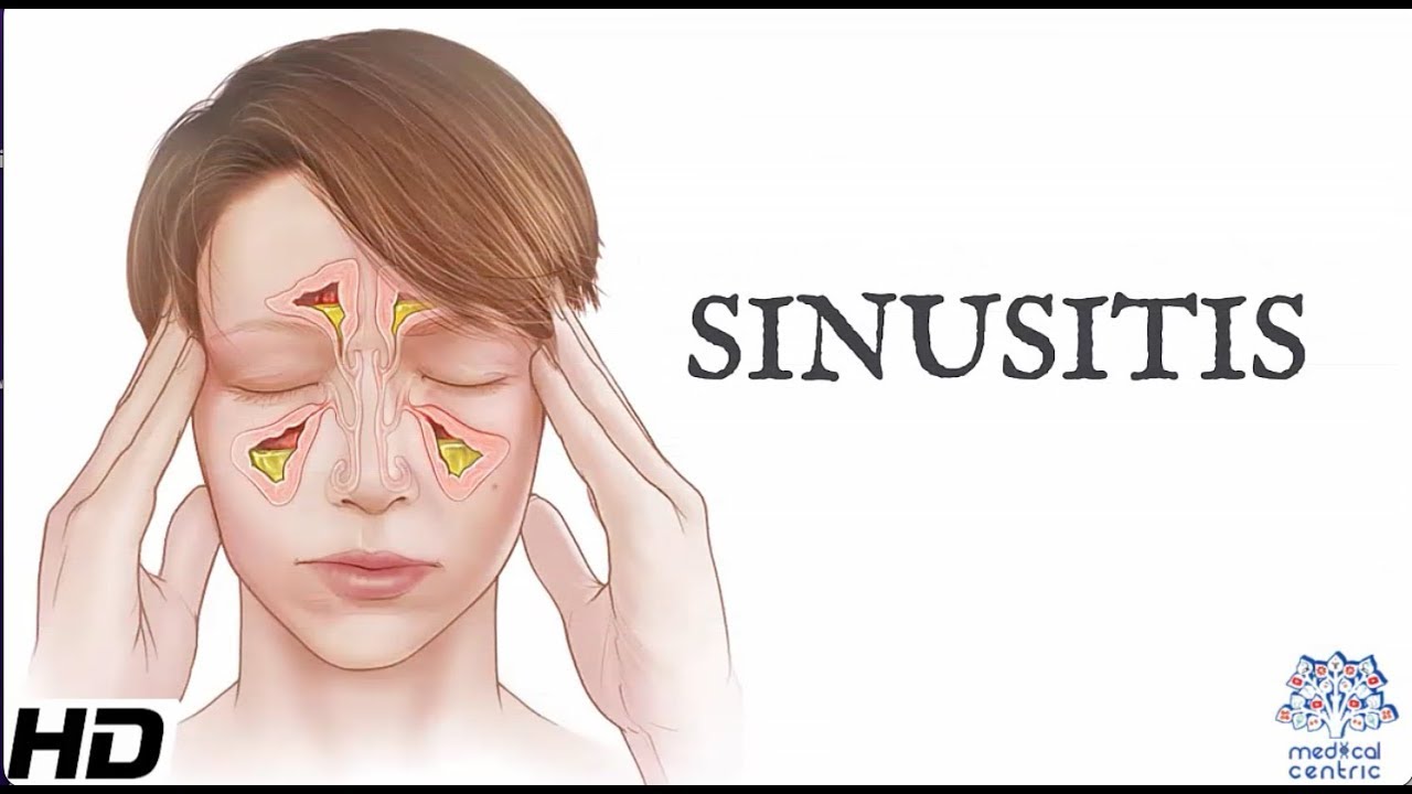 Sinusitis: Everything You Need To Know