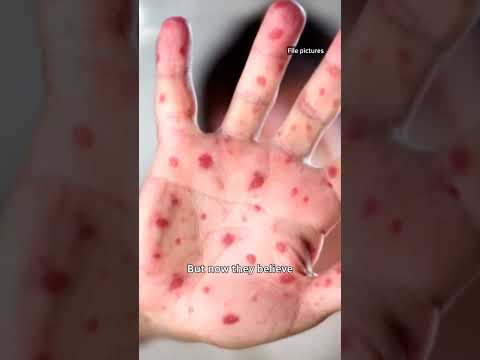 Health authority warns of measles cases in small B.C. community