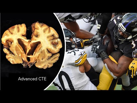 NFL concussions: 96% of former NFL players tested had CTE brain disease - Compilation