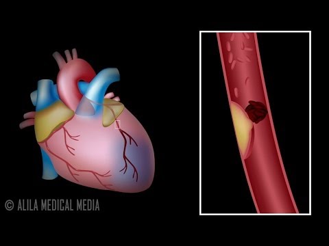 Myocardial Infarction and Coronary Angioplasty Treatment, Animation.