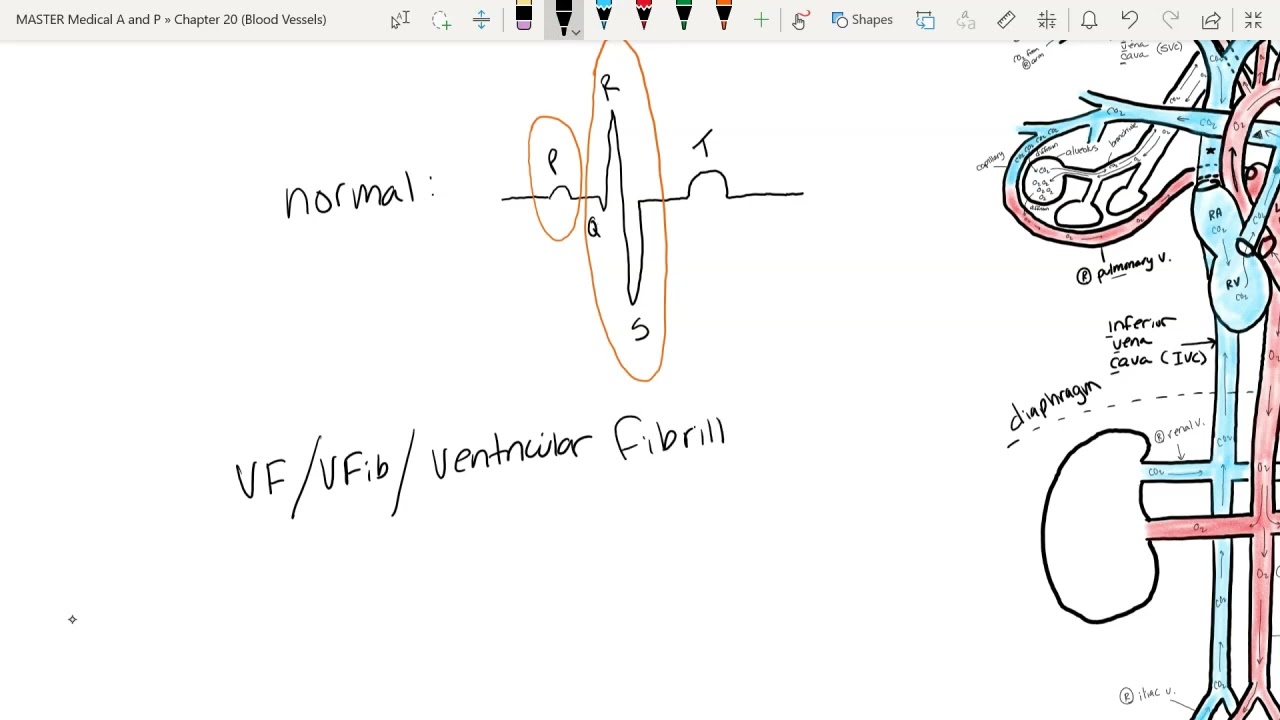 Understanding Heart Rhythms: Normal, Ventricular Fibrillation, and ...