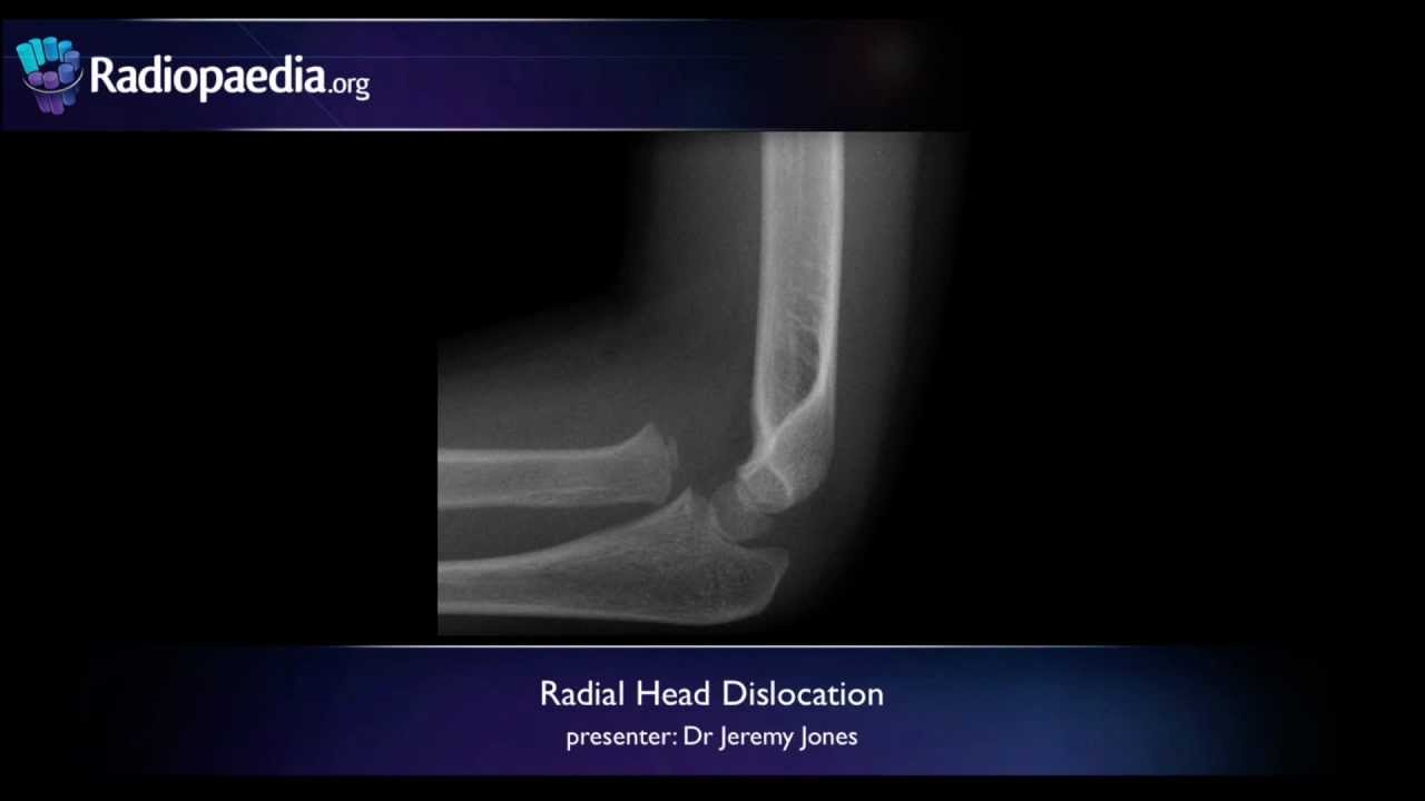 Radial head dislocation - radiology video tutorial (x-ray)