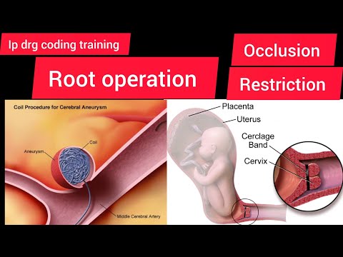 ICD-10 PCS coding Root operation-OCCLUSION & RESTRICTION