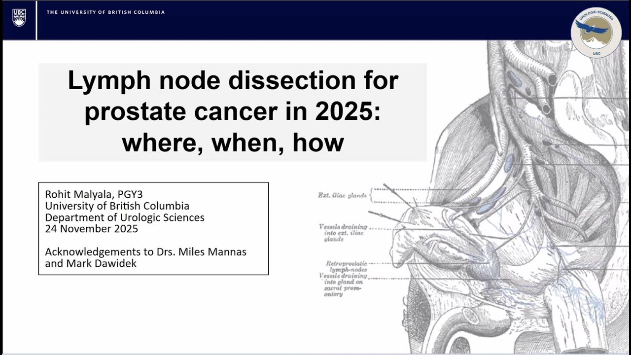 Lymph node dissection for prostate cancer in 2025: where, when, how