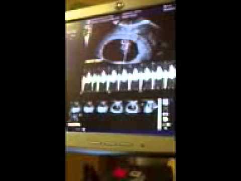 The first heartbeat of my very own baby 168 bpm
