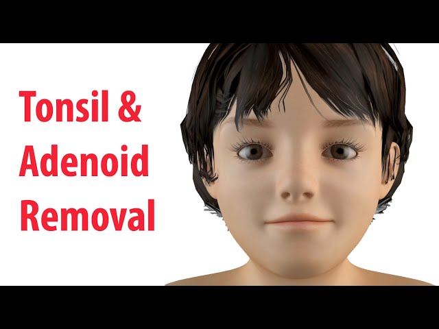 Adenoid