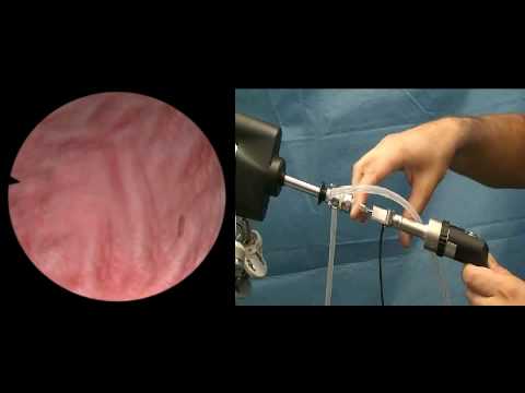 Camera optics TURP Prostate surgical procedure