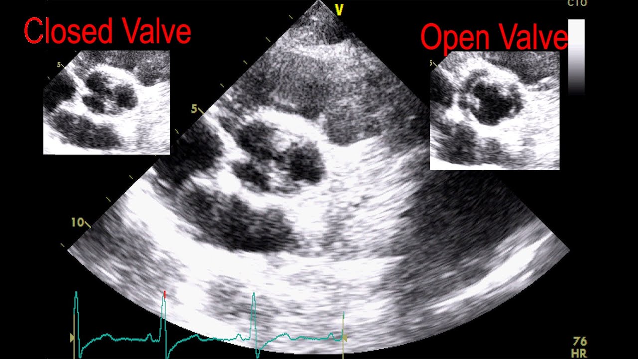 Aortic Stenosis Parasternal Short Axis Aortic Valve - Loop