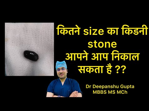 What Size kidney stone passes naturally??? Dr Deepanshu Gupta