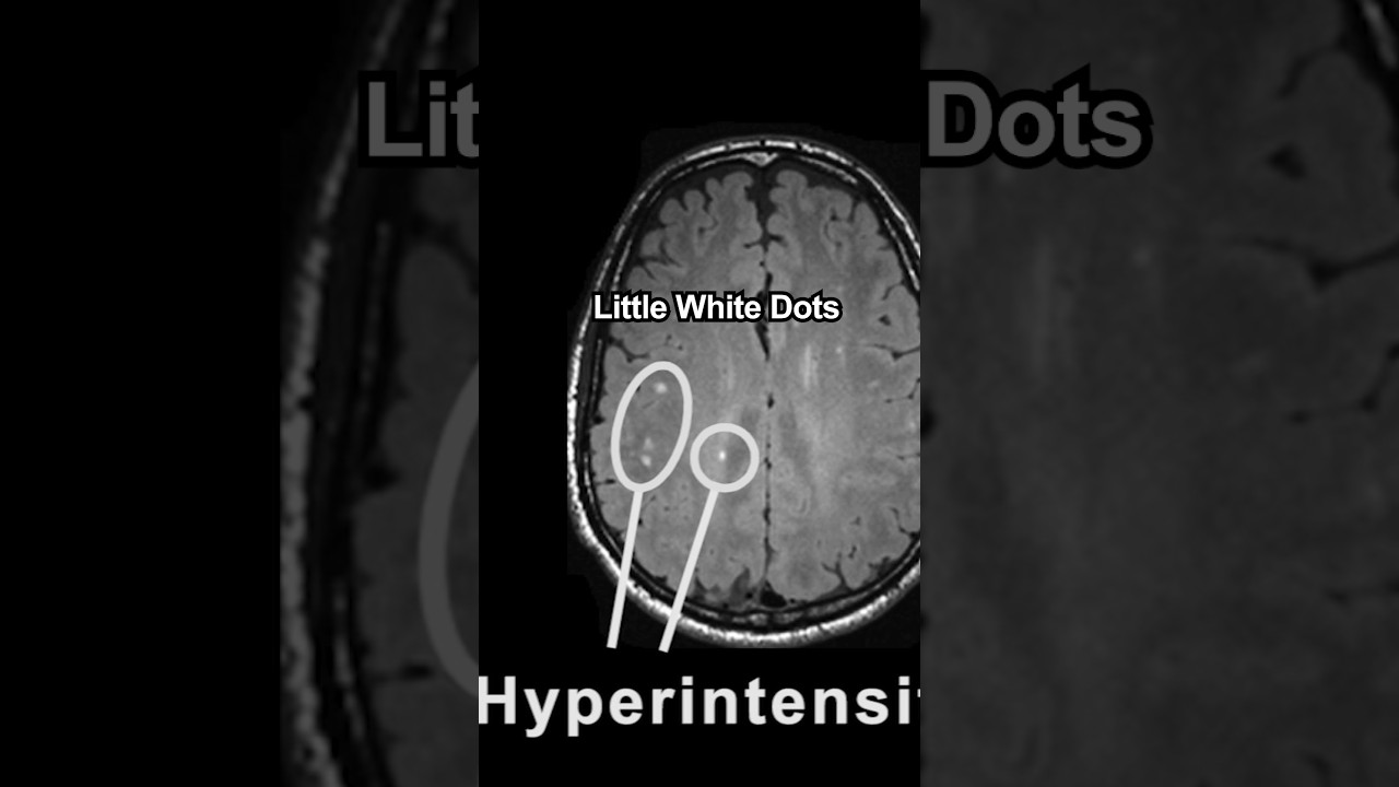 What Are These Dots? #shorts #mri #brain #movementdisorder #walking #aging #health #uctv #science