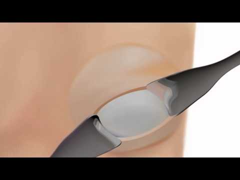 Mastectomy Surgery | Johns Hopkins Medicine