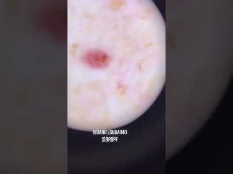 Skin Cancer Awareness: Basal Cell Carcinoma