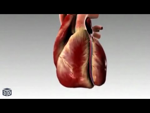 Heart attack and congestive Heart Failure in 3D