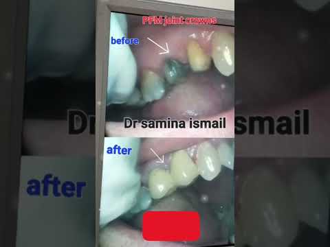 PFM joint crowns@Dr samina ismail #cosmatic #oralhealth #dentistry #smiledental #teeth #teeths
