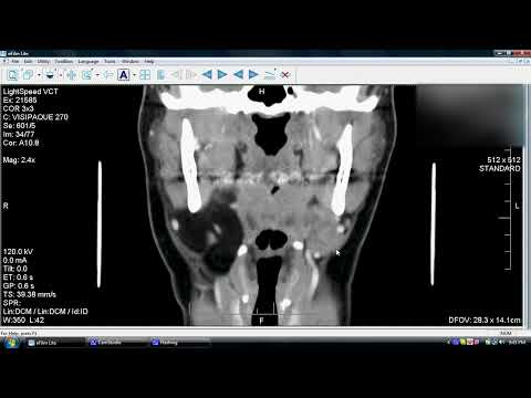 CT Scan of my head and neck