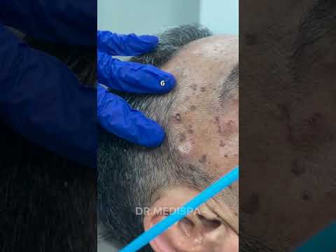 Say goodbye to the unwanted moles, skin tags or any lesions | Dr. MediSpa
