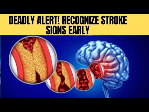 Recognize the Signs and Symptoms of Stroke | Signs of Stroke | Stroke Symptoms | Brain Stroke