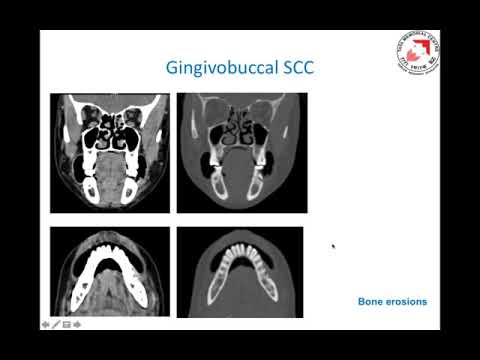 Imaging of oral cancer: What do the surgeons want? Dr Amit Janu
