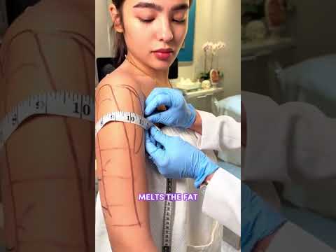 How Andrea Brillantes lose arm fat . V contour by Dra. Vicki Belo