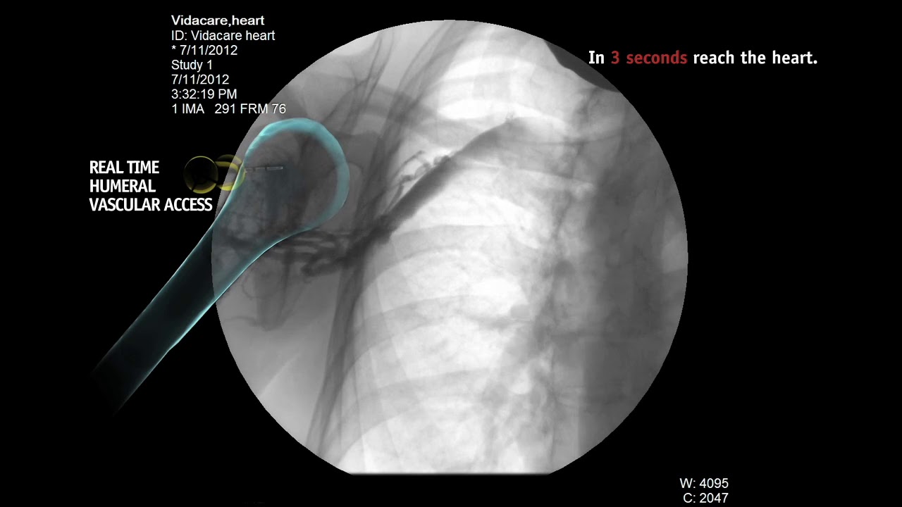 Intraosseous Infusion From Right Humeral Head