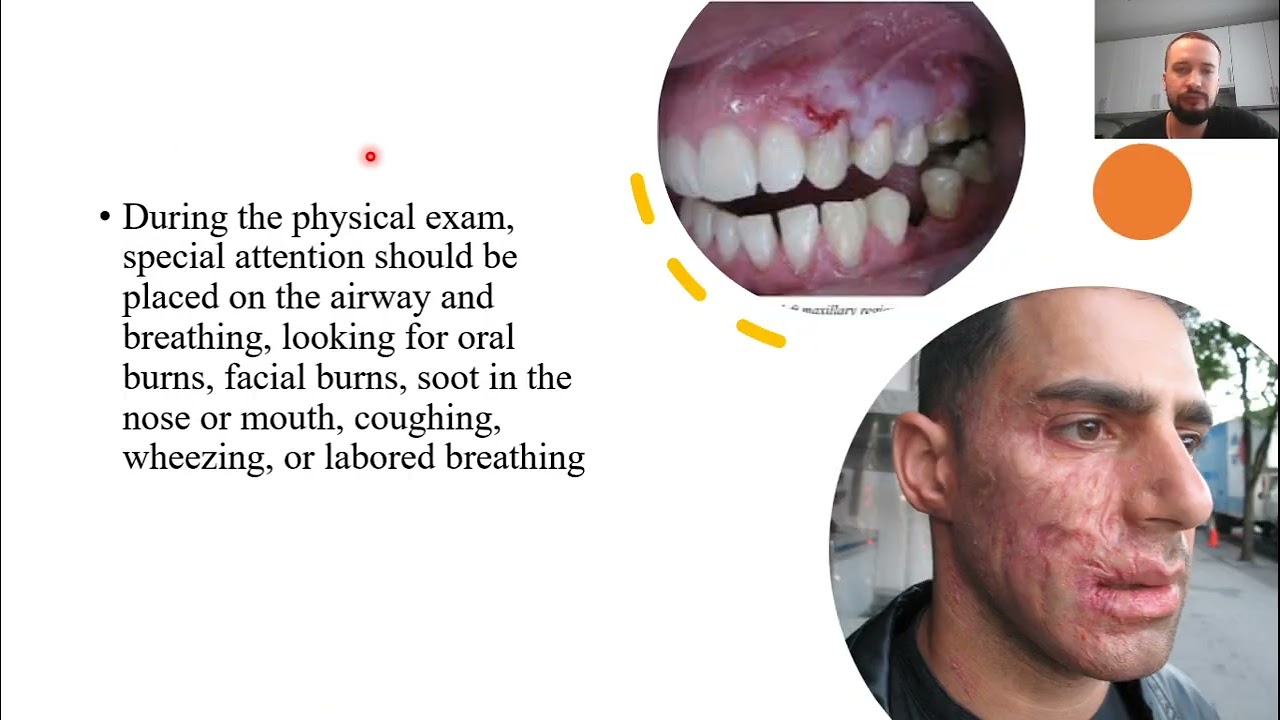 Understanding Thermal Burns: Causes, Treatment, and Prevention | Galaxy.ai