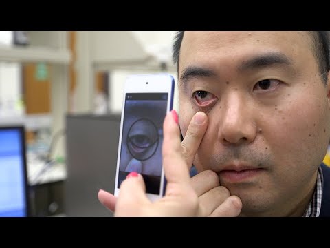Spectroscopic analysis with a smartphone app to help assess anemia