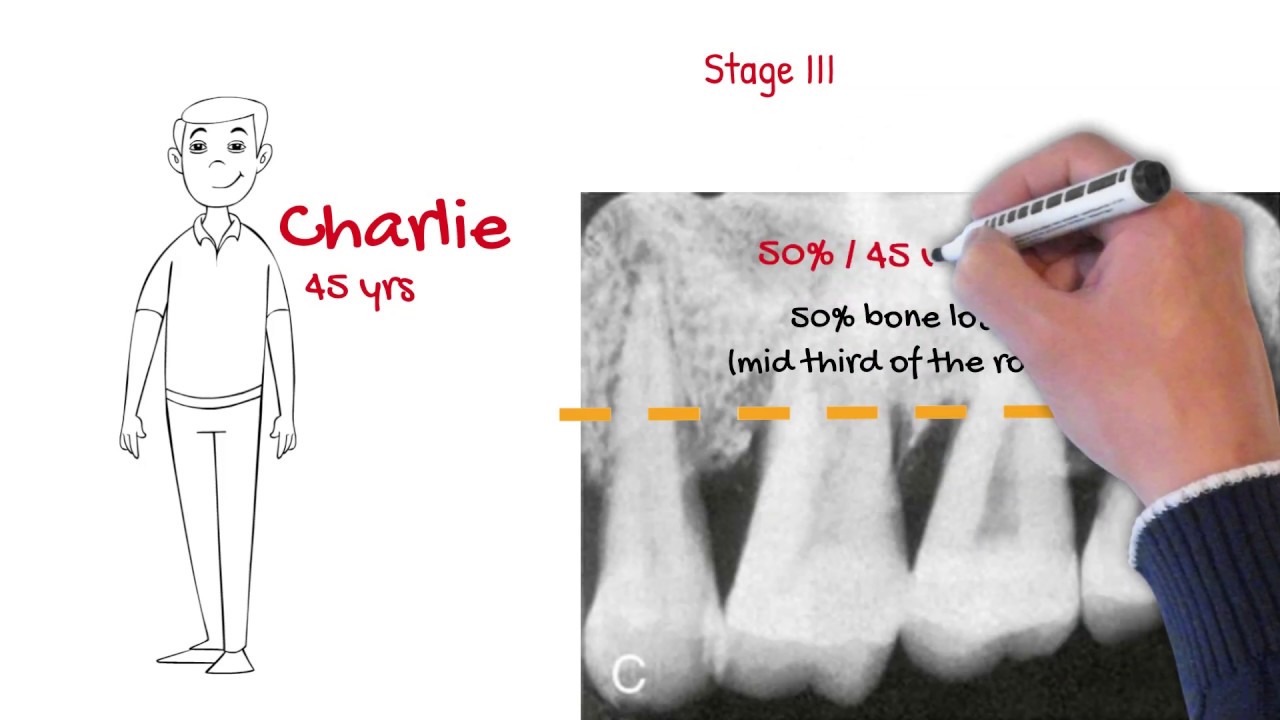 The new periodontal classification *MUST WATCH FOR ALL DENTISTS*
