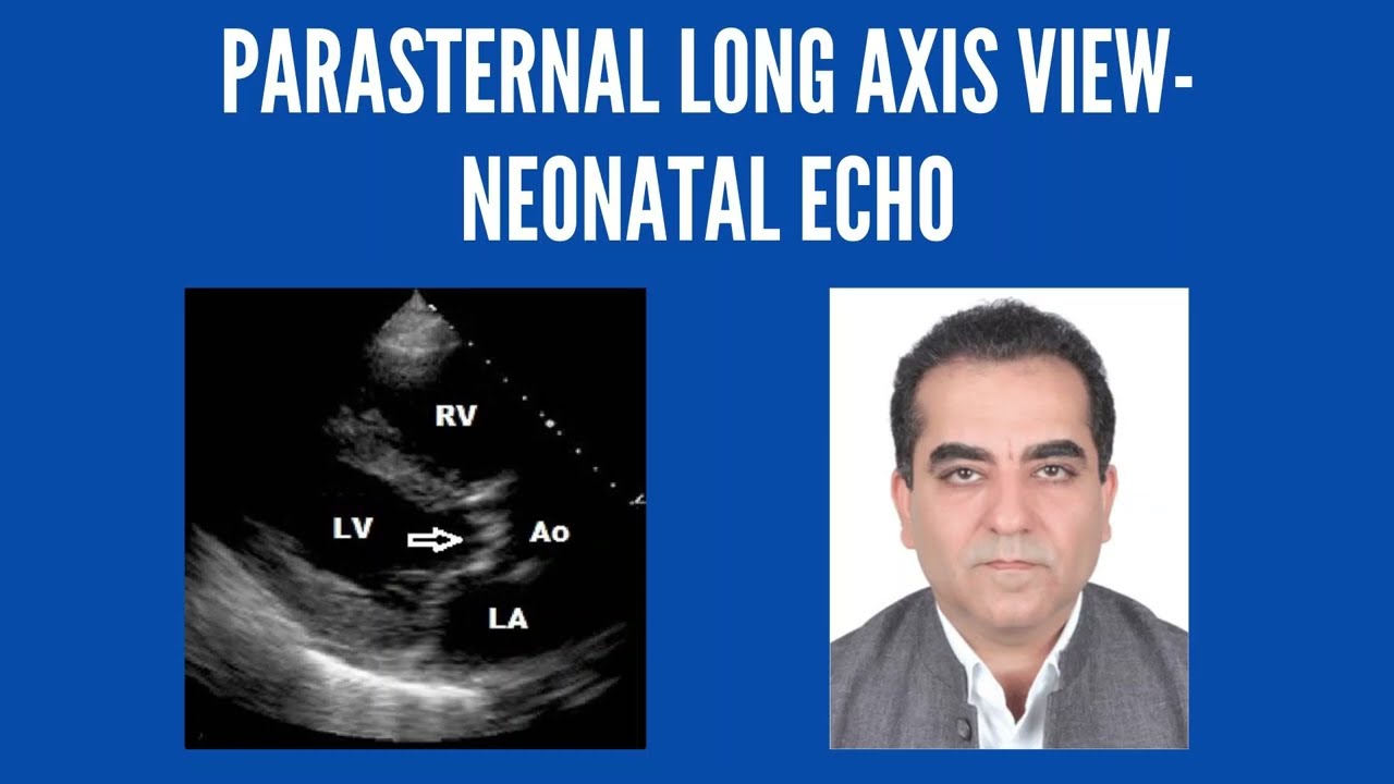Neonatal echo l Parasternal long axis view #echo