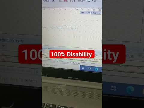 bera test for hearing