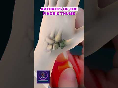 Arthritis of the Finger and Thumb