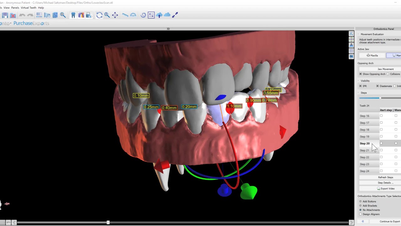 BSP 4.7 Ortho - Step Creation