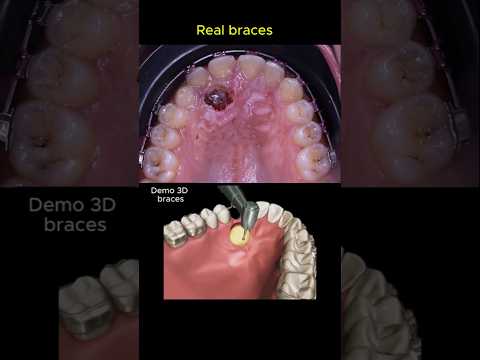 Impacted tooth traction with braces #orthodontist #braces #dentist