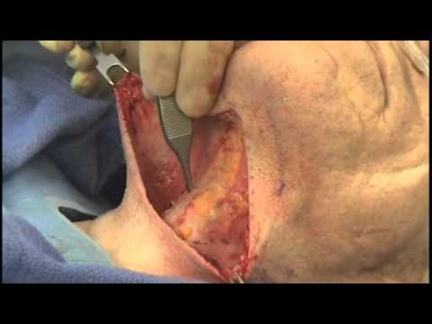 The Lapel Lift (Cosmetic Z-plasty) for Double Chin and Turkey Neck
